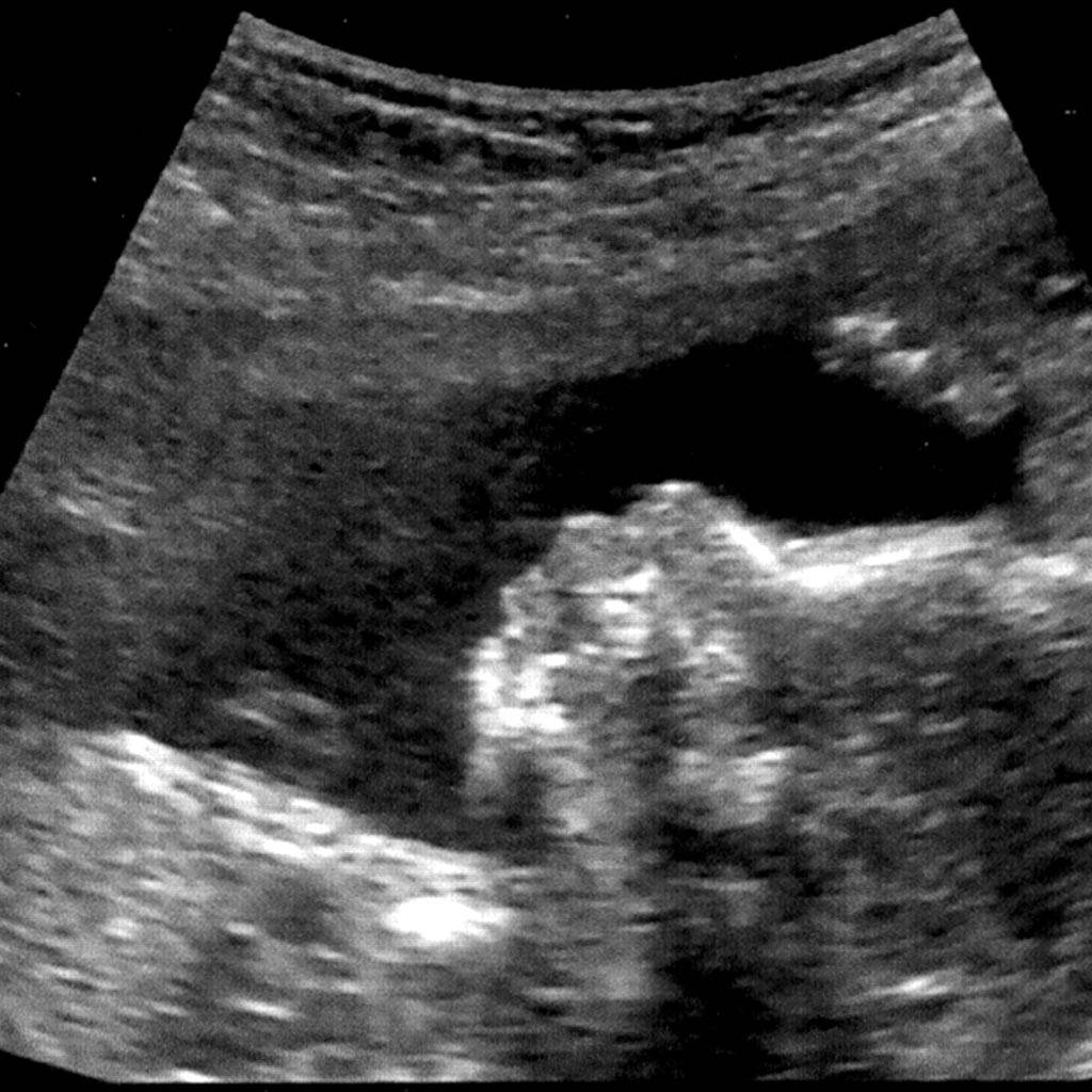 Ecografia 3D in sarcina - Bebelu.ro